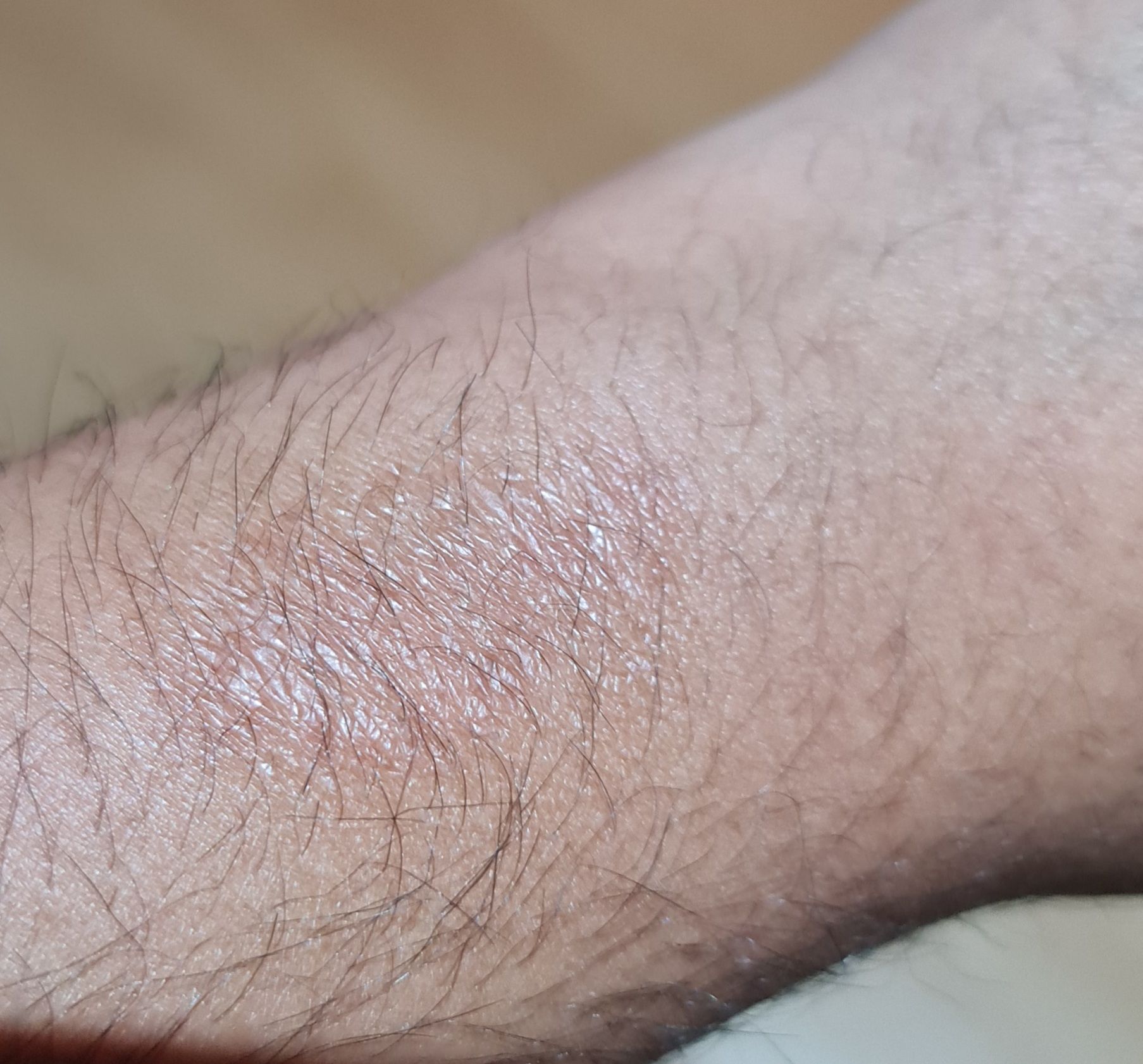 Galaxy watch 4 Burn on wrist - Samsung Members