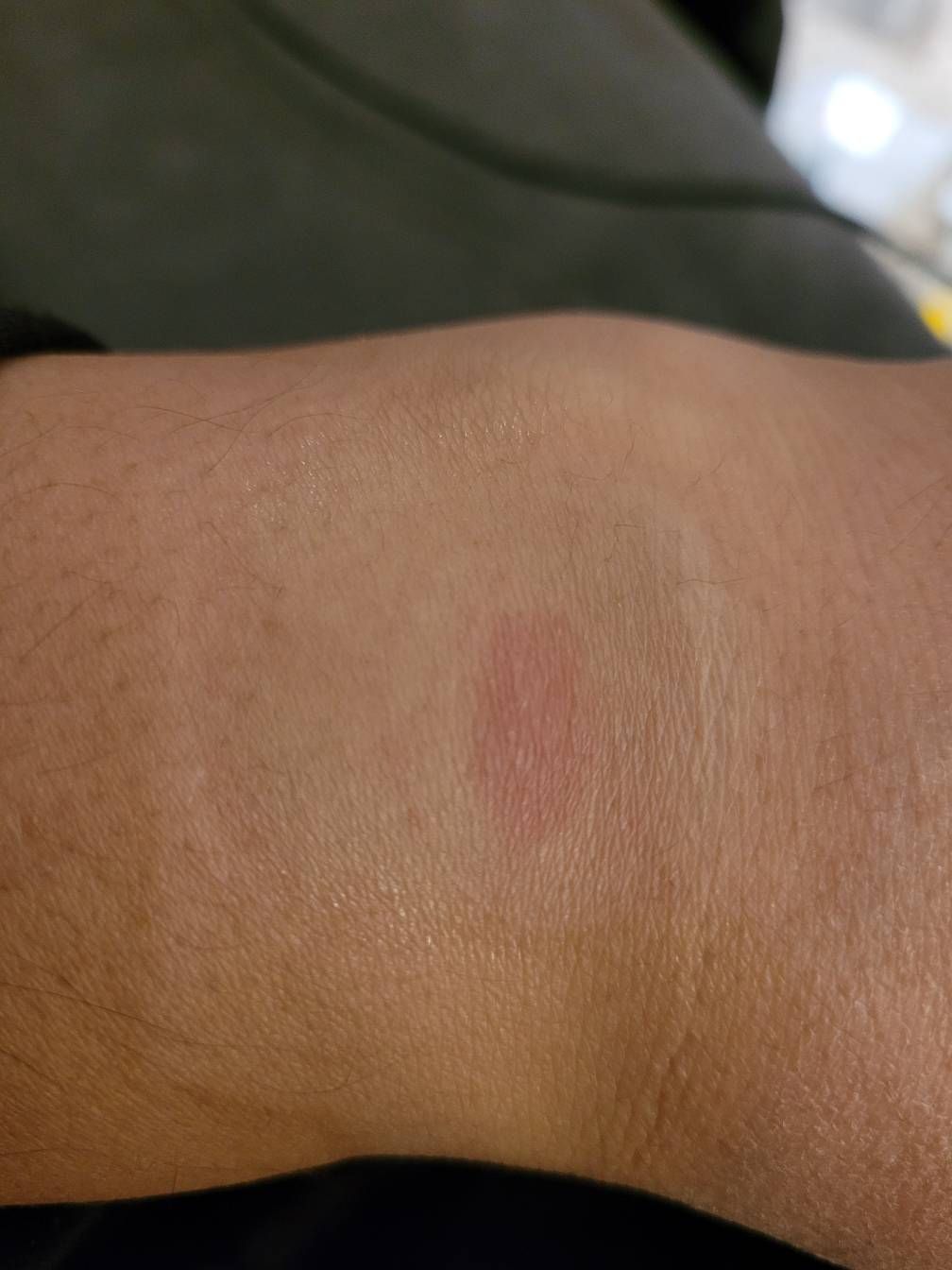 Galaxy watch 4 Burn on wrist - Samsung Members