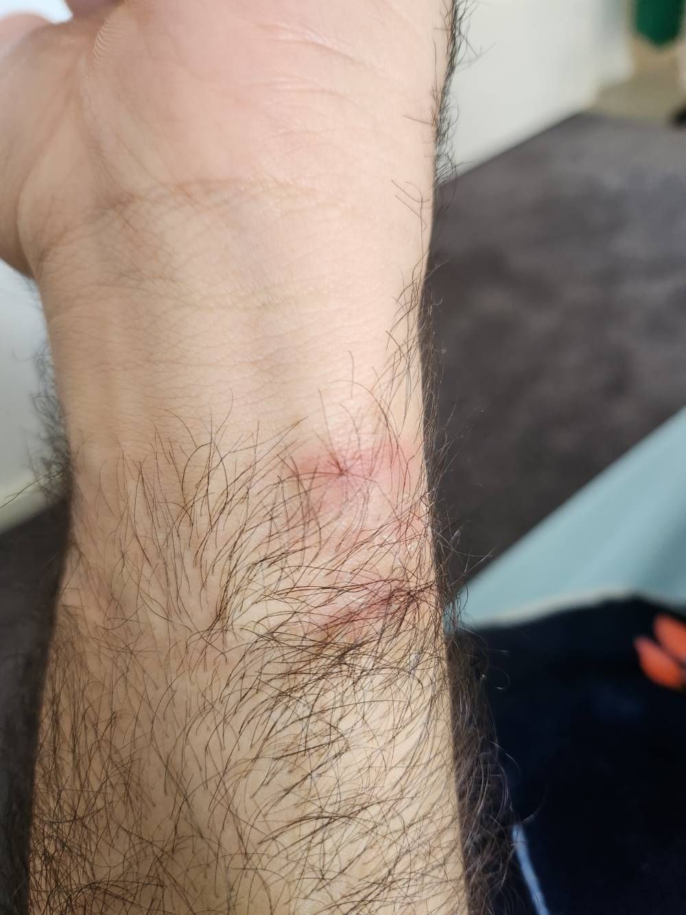 Getting rashes and burns from watch 5 - Samsung Members