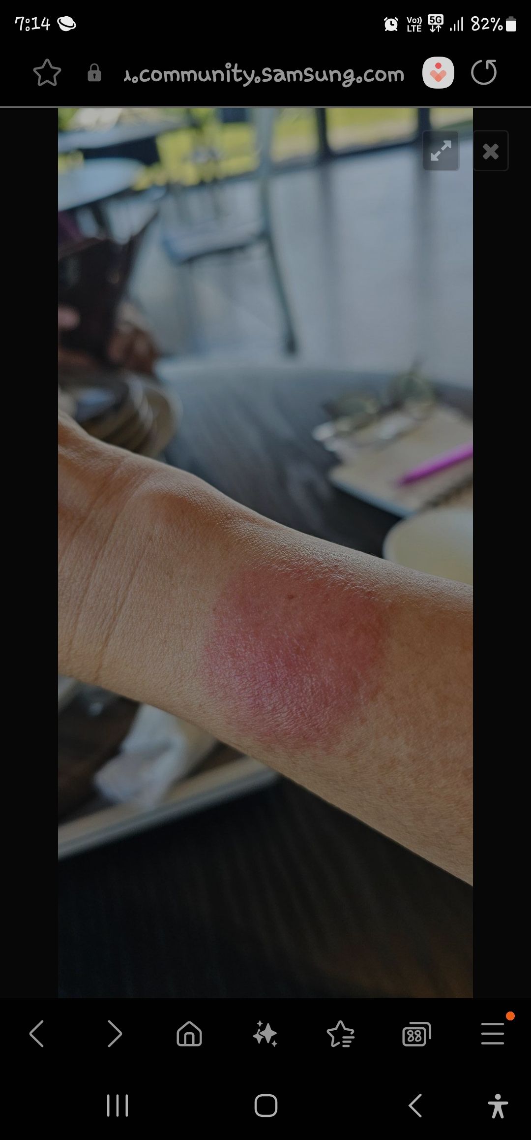 Solved: Wrist burn - Samsung Members